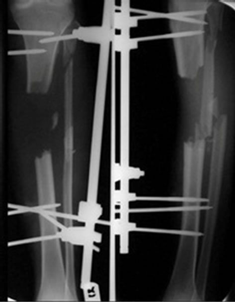 Bone Transport in Tibial Gap Non-Union—A Series of 25 Cases