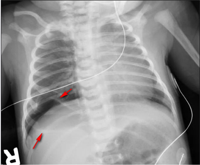Post-Natal Spontaneous Resolution of a Congenital Pulmonary Airway ...