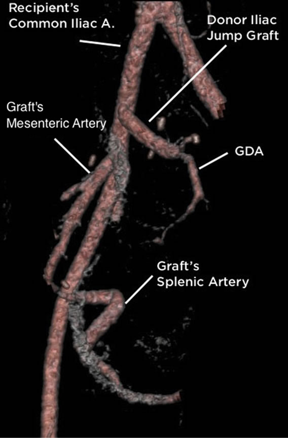 Gastroduodenal Artery Reconstruction as Salvage Procedure for Pancreas ...