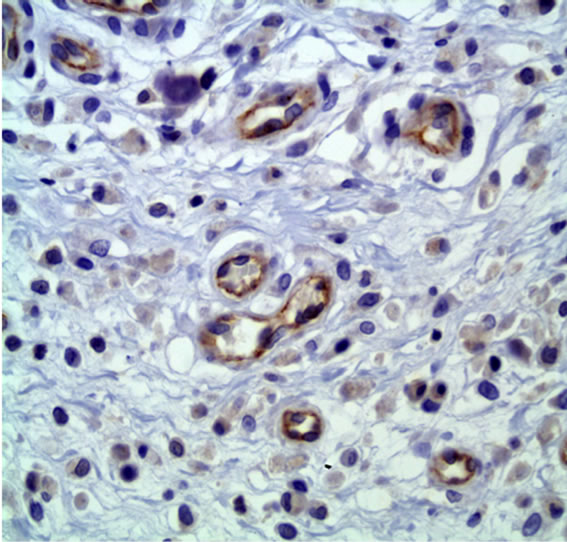 Quantitative Analysis of Photodynamic Therapy Effects in Rat Mammary ...