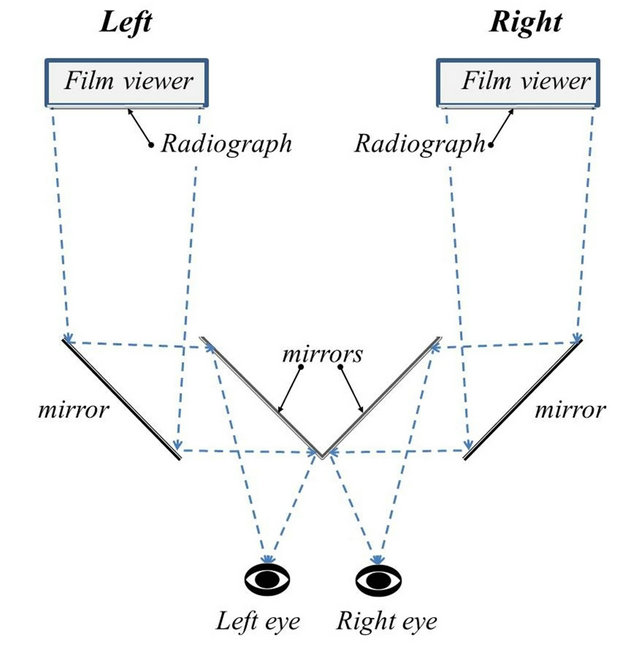 Fast and Low Cost X-Ray Stereoradiography Displayed on a 3D Monitor