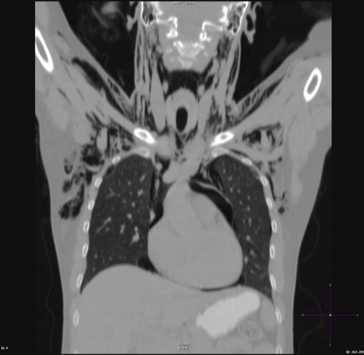 Cervico-Facial Soft Tissue Emphysema with Pneumo-Mediastinum Following ...
