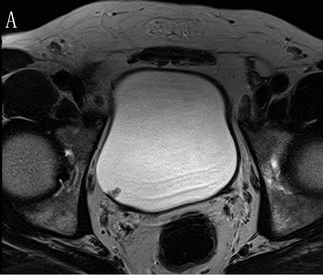 Urinary Bladder Cancer: The Current and Potential Role of MR Imaging in ...