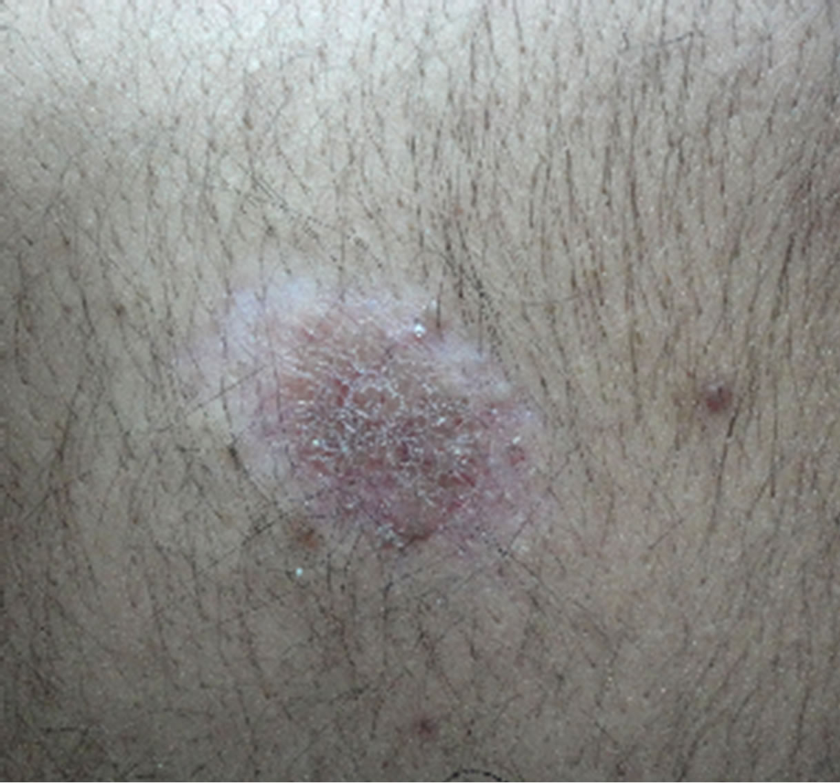 Debulking of Keloid Combined with Intralesional Injection of 5 ...