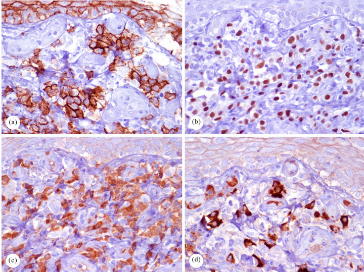 Zoon’s balanitis with mucinous metaplasia: A case report and review of ...