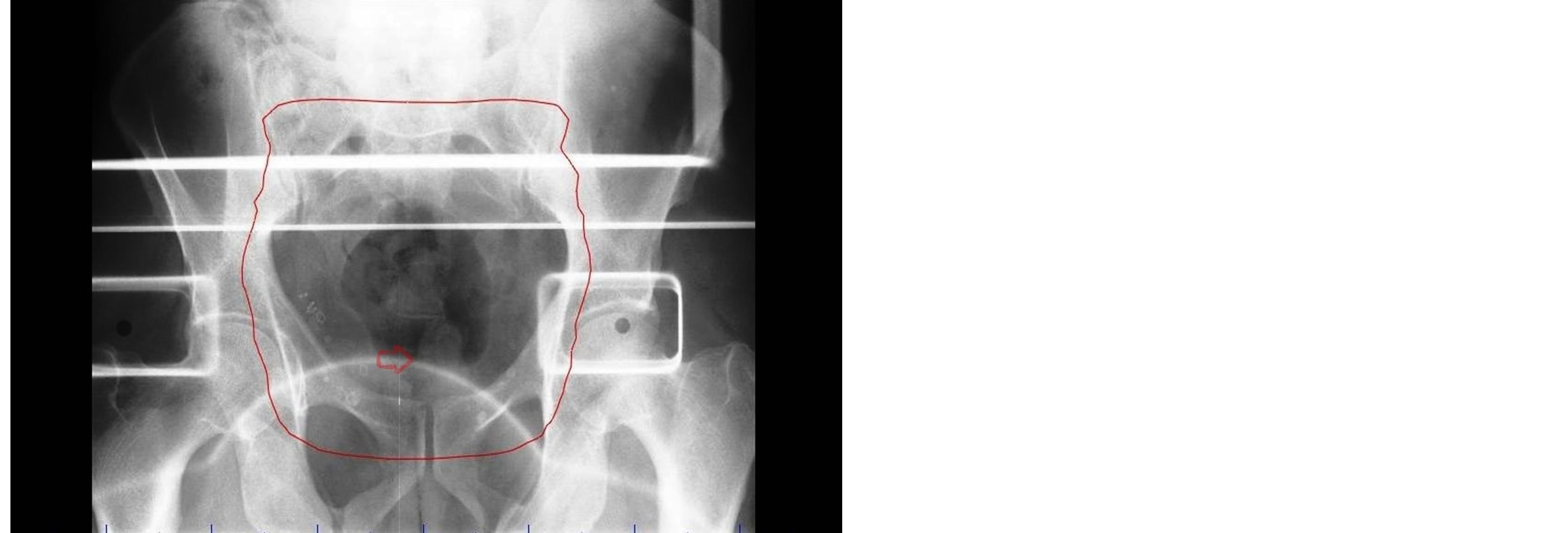 Unusual Case of Radiation Induced Balanitis after Chemoradiation for ...