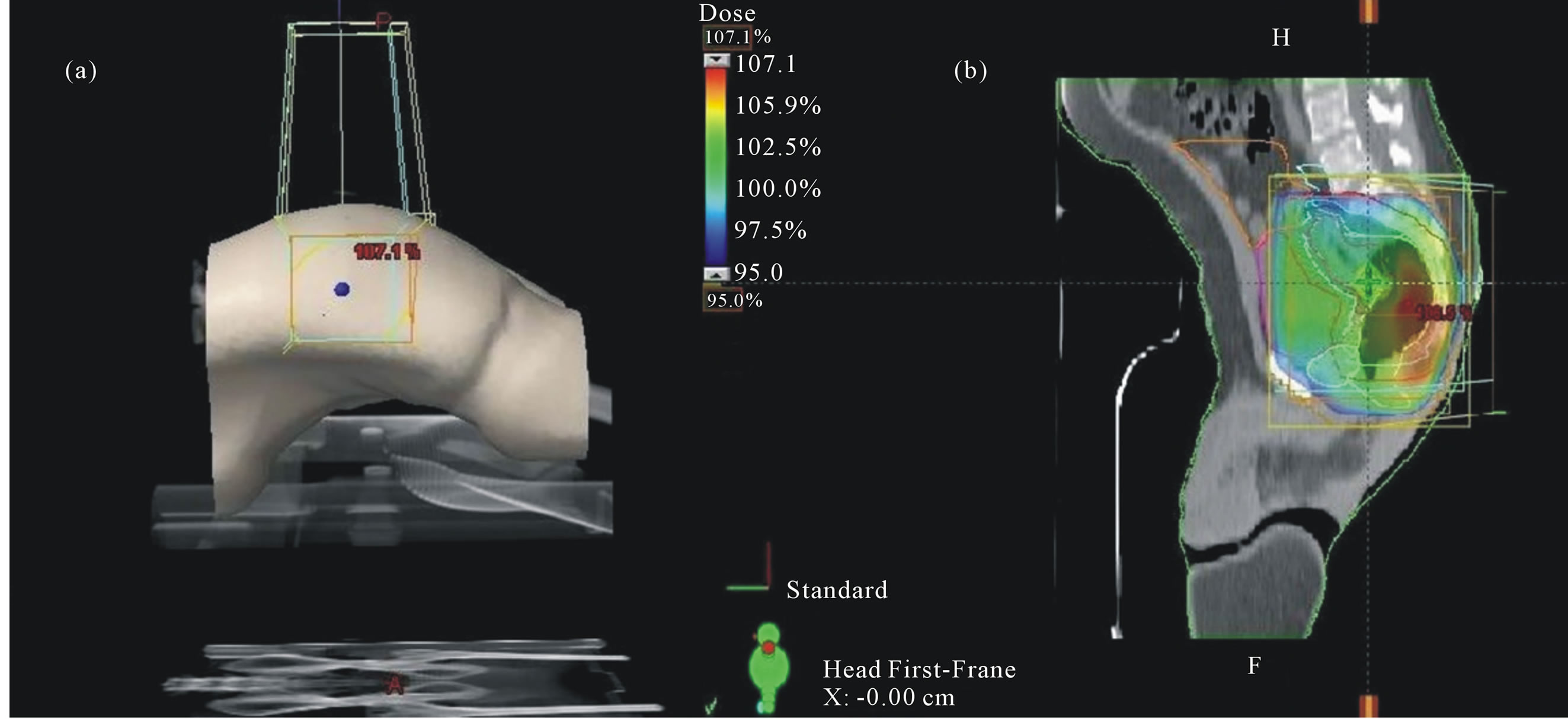 Unusual Case of Radiation Induced Balanitis after Chemoradiation for ...