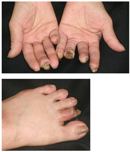 Arterial Imaging in Digital Gangrenes Associated with Scleroderma ...