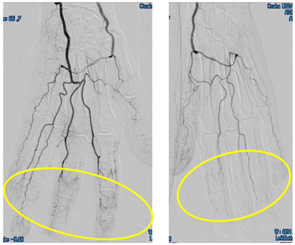 Arterial Imaging in Digital Gangrenes Associated with Scleroderma ...