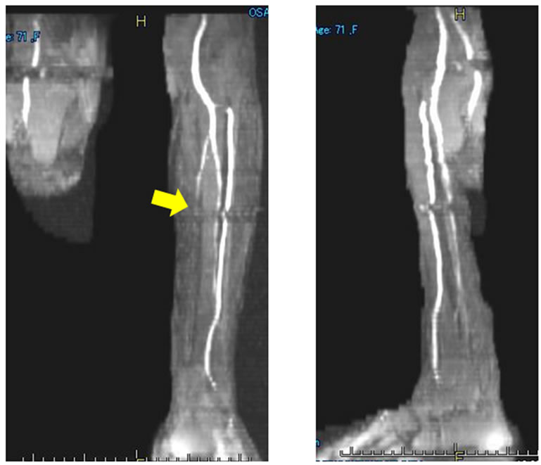 Arterial Imaging in Digital Gangrenes Associated with Scleroderma ...