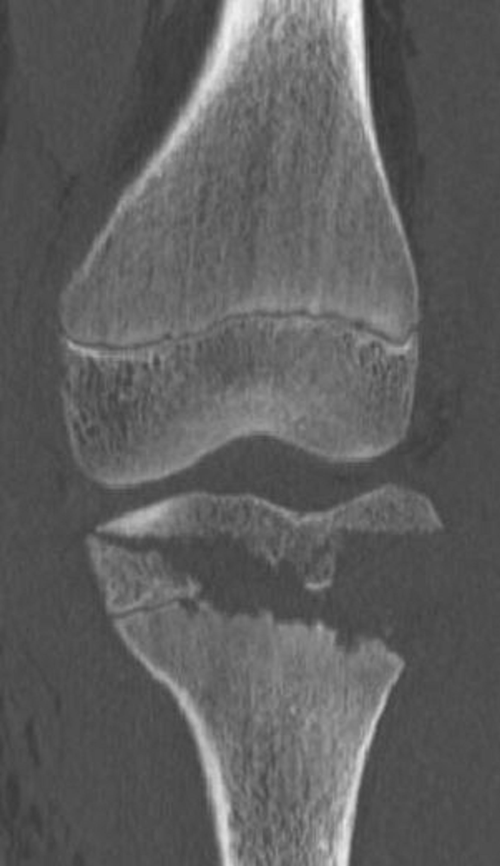 Imaging Review of Adolescent Tibial Tuberosity Fractures