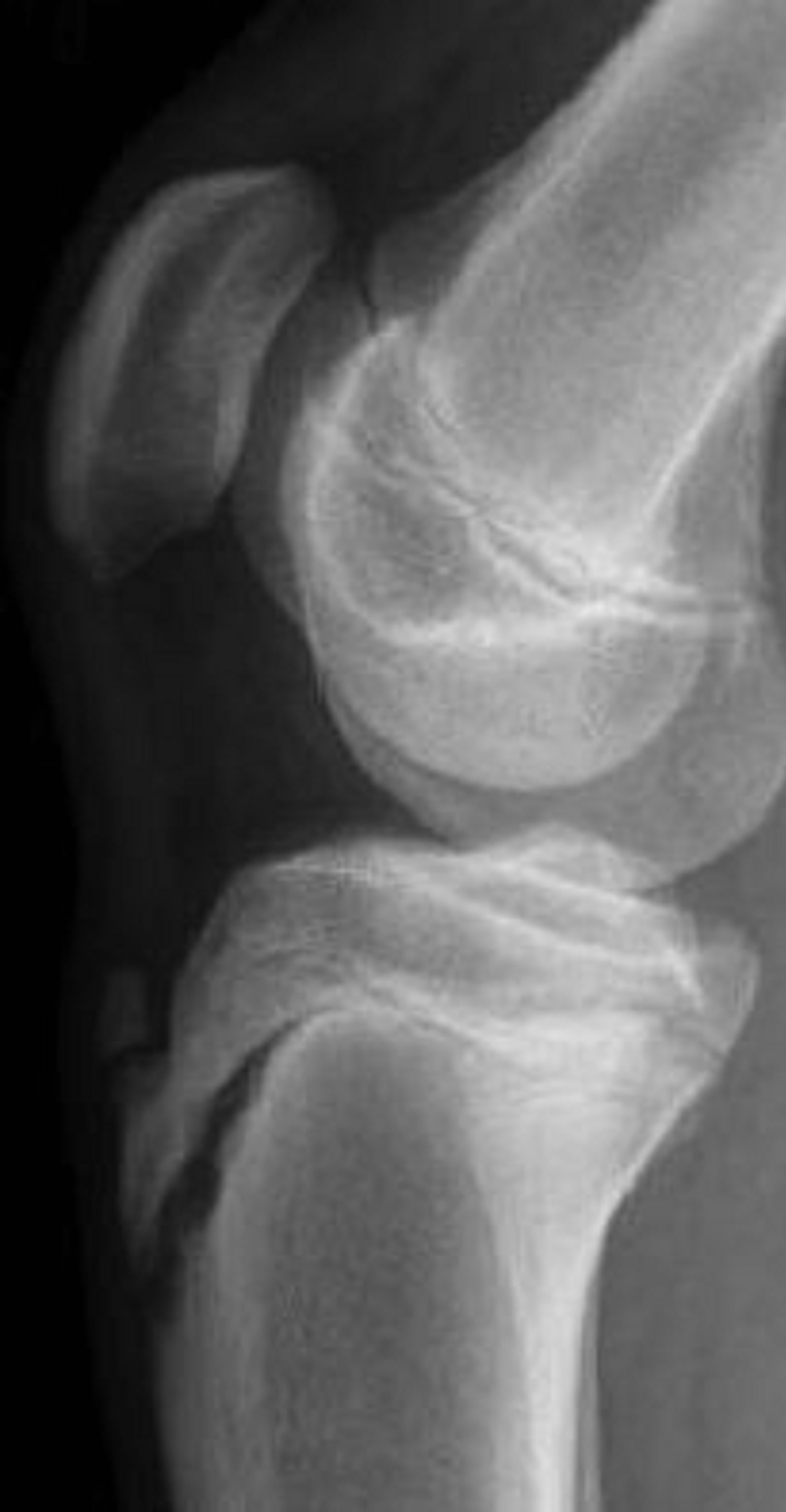 Imaging Review of Adolescent Tibial Tuberosity Fractures
