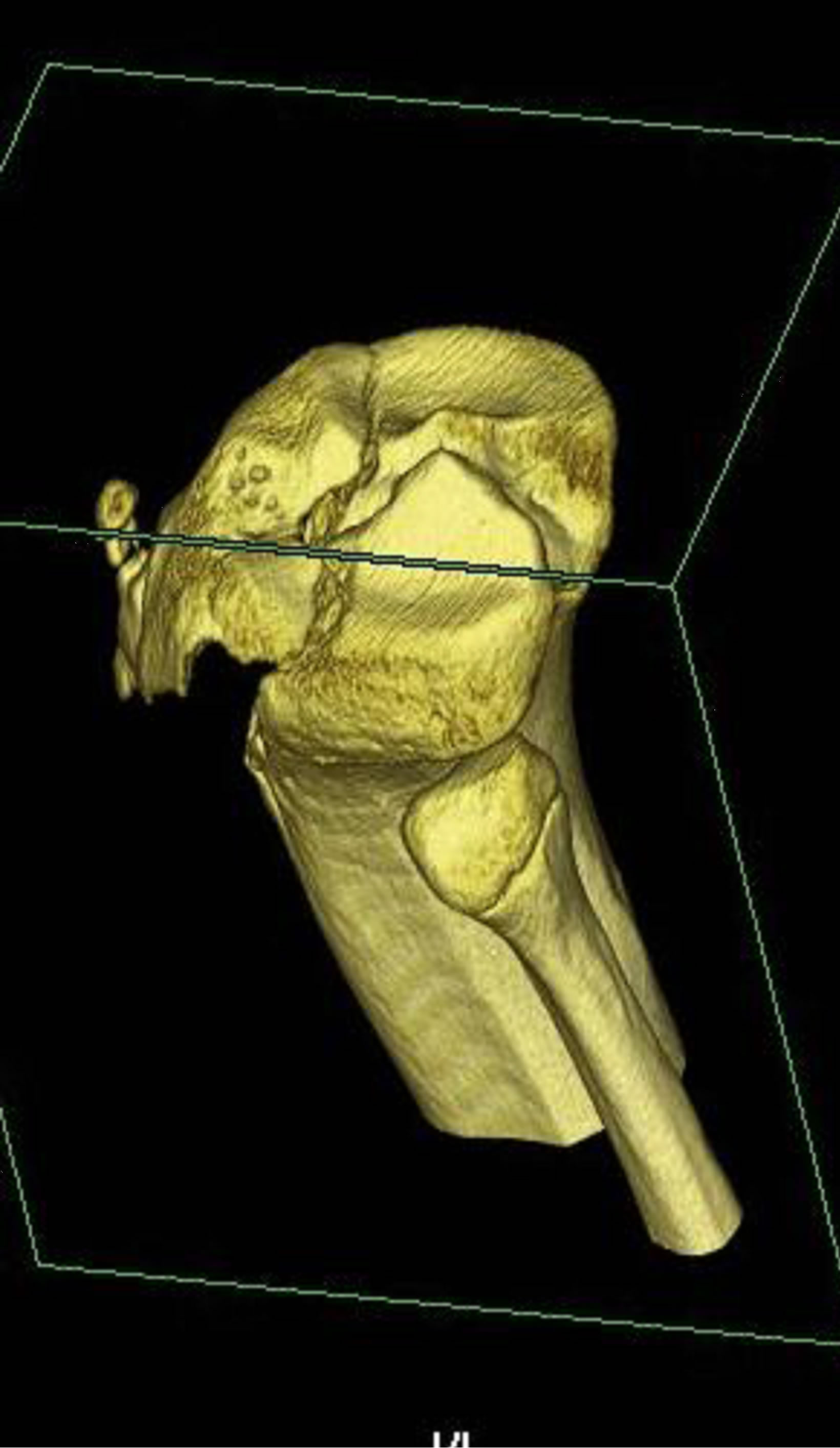 Imaging Review of Adolescent Tibial Tuberosity Fractures