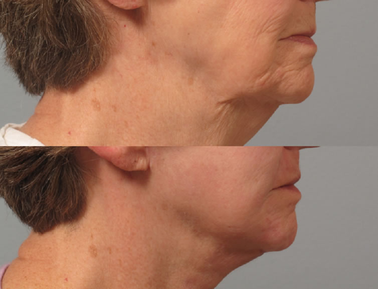 Non-Excisional Face and Neck Tightening Using a Novel Subdermal ...