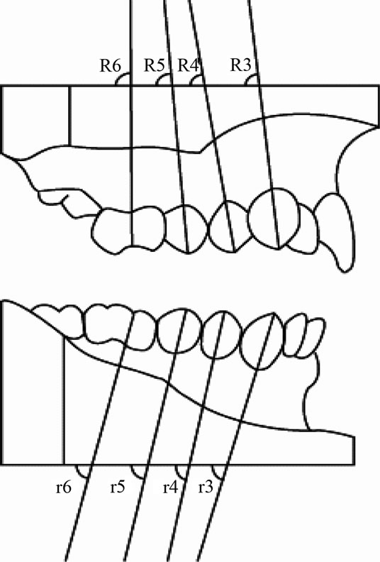 Changes in the crown angulation and dental arch widths after ...