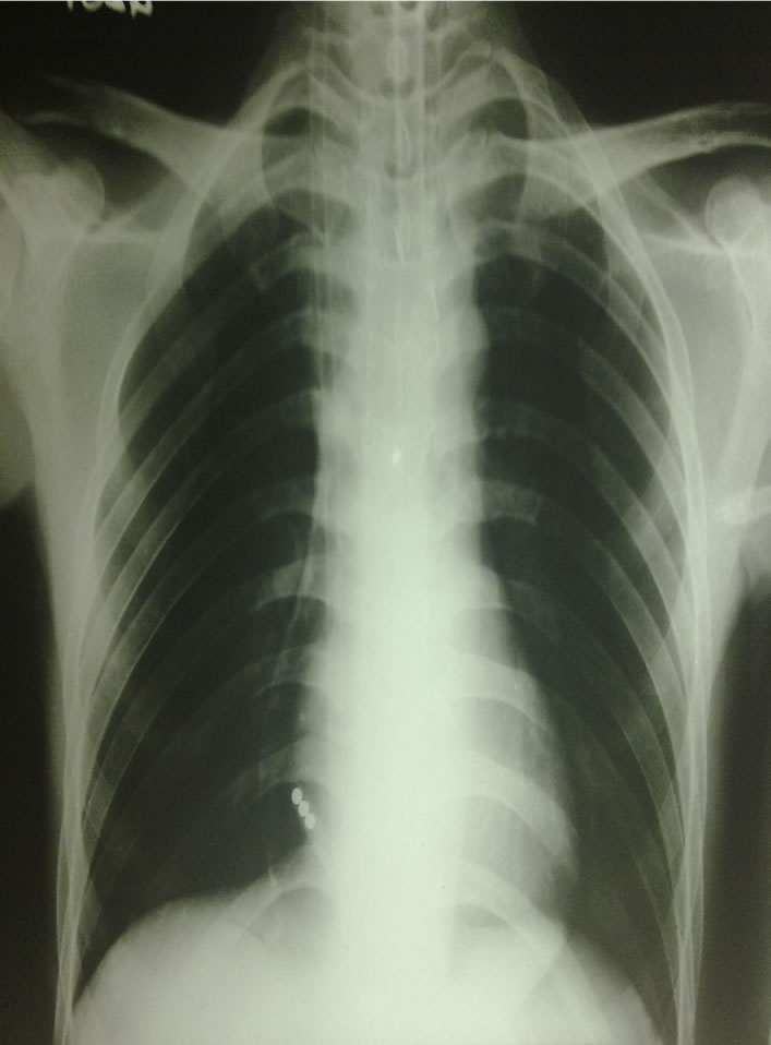 The Nasogastric Tube in the Thorax after Gastric Pull Up!