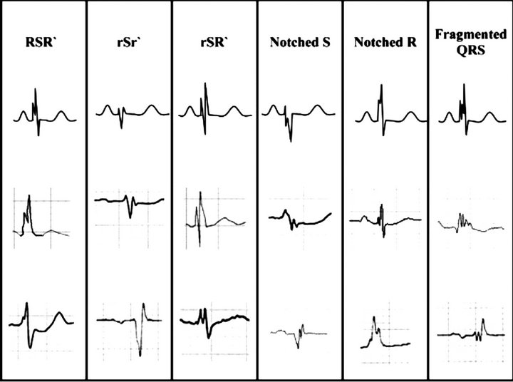 QRS Fragmentation as a Prognostic Test in Acute Coronary Syndrome