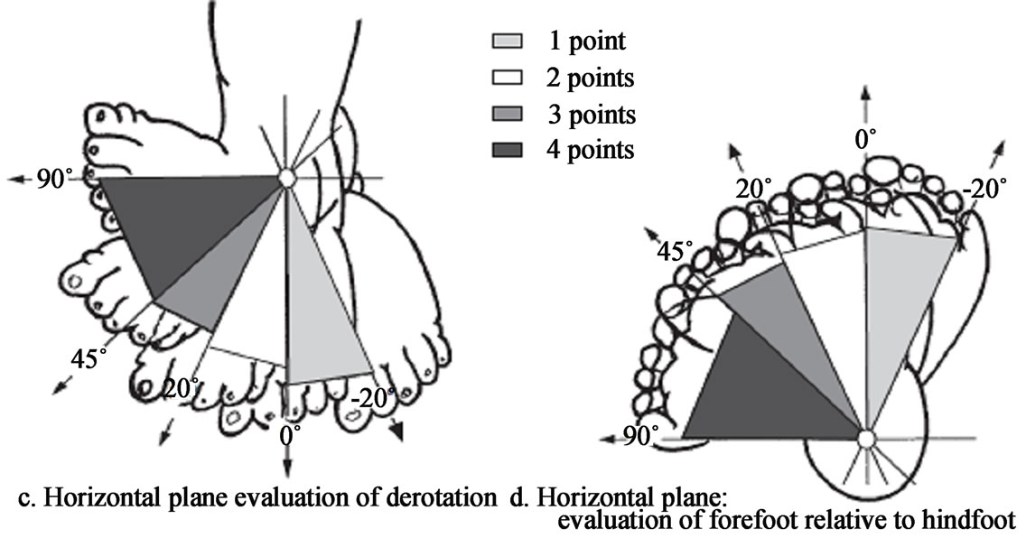 Congenital Club Foot in Children Younger than 24 Months: Decancelous ...