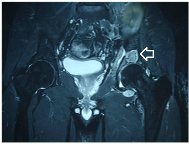 Periacetabular Brucella Osteomyelitis