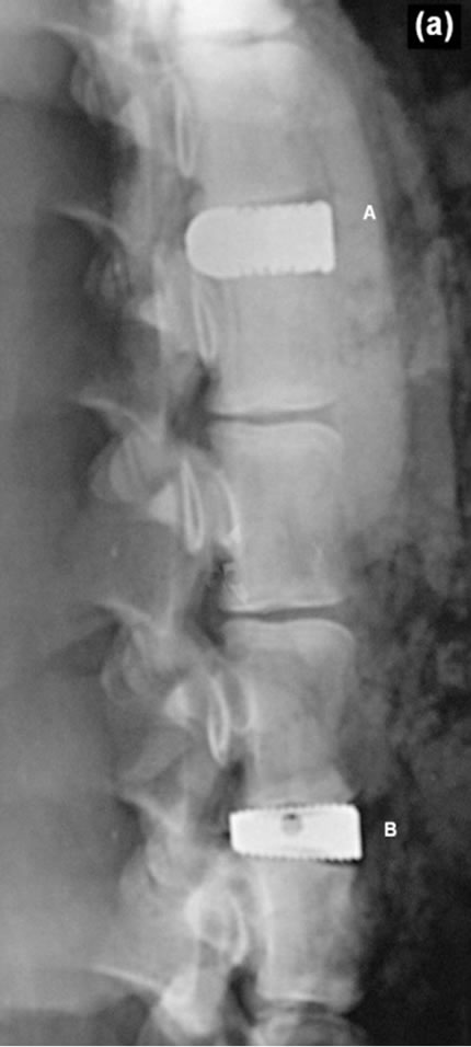 Score Evaluation of MRI Sequence Type Related Artifacts after Interbody ...