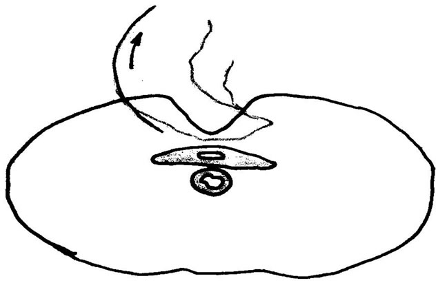 Excision and Partial Primary Closure of Wound for Pilonidal Disease