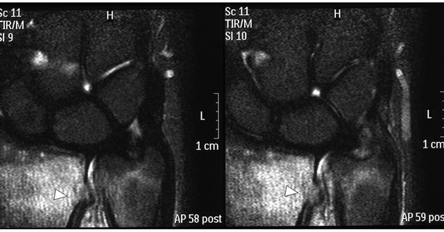 A Case Report of Oseoid Osteoma in the Ulnar Cortex of the Distarl ...