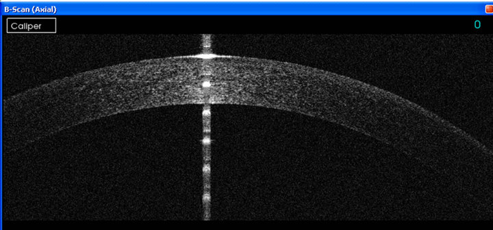Repeatability of 3D OCT Pachymetry in Eyes with and without Contact ...