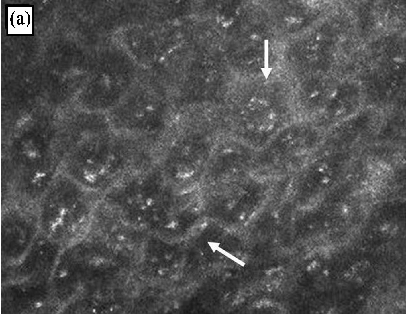 Nevus changed by recurrent Herpes simplex infection: Reflectance ...