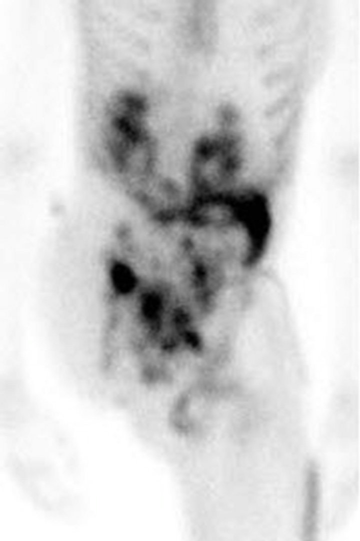 Metastatic peritoneal sarcomatosis from radiation-induced osteosarcoma ...