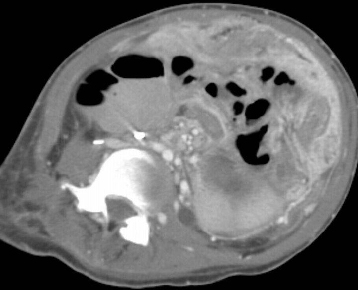 Metastatic peritoneal sarcomatosis from radiation-induced osteosarcoma ...