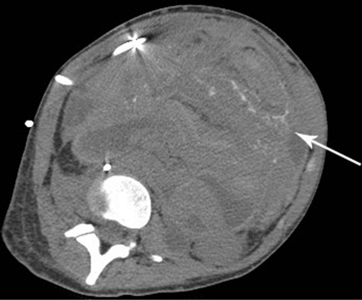 Metastatic peritoneal sarcomatosis from radiation-induced osteosarcoma ...