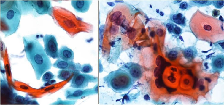 Tzanck Cells Pemphigus Vulgaris