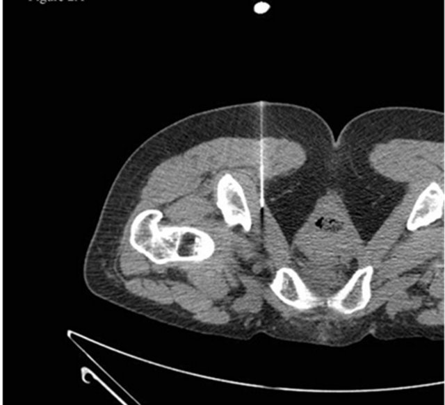 Ct Guided Pudendal Nerve Block