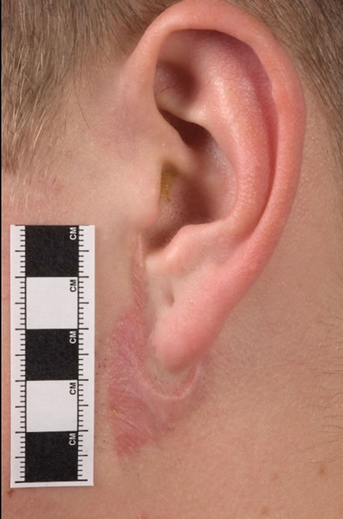 Uncommon Presentation of a Preauricular Sinus