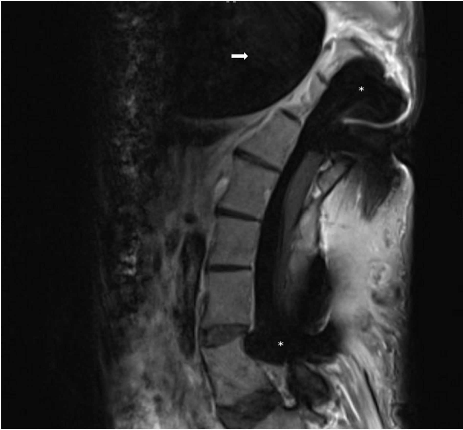 Giant Thoracic Meningocele Causing Acute Respiratory Compromise