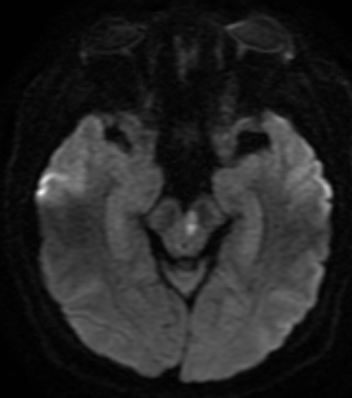 A Rare Case of Isolated Left Medial Midbrain Stroke