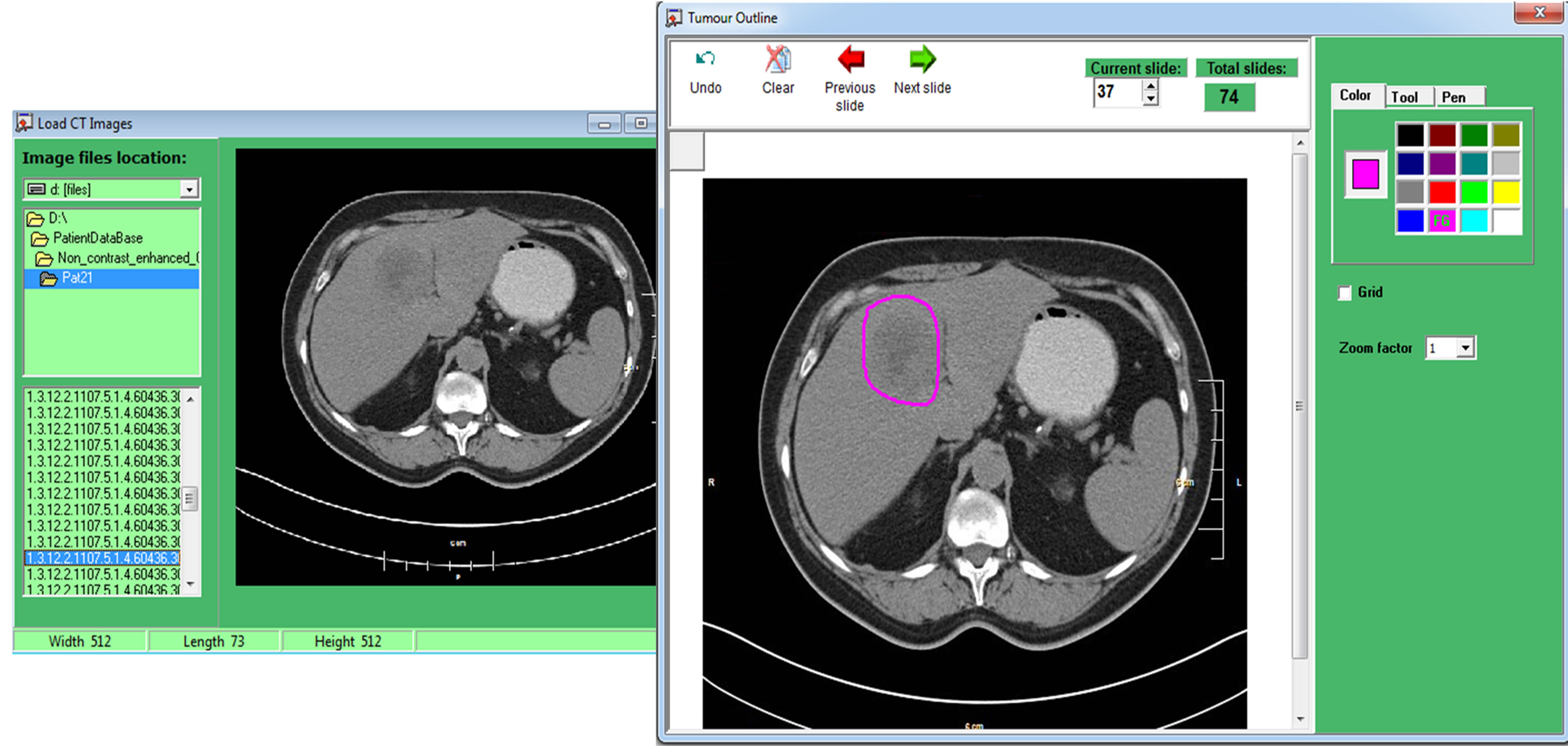 Image Processing Tool Promoting Decision-Making in Liver Surgery of ...