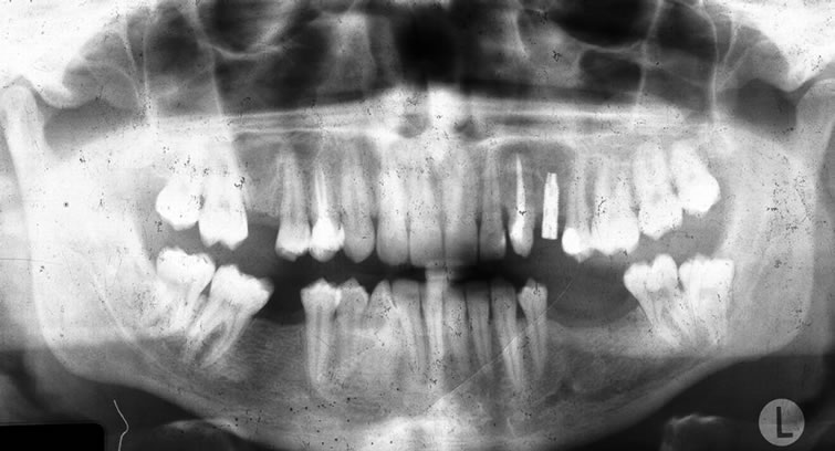5-year follow-up of a patient with an impacted maxillary canine ...