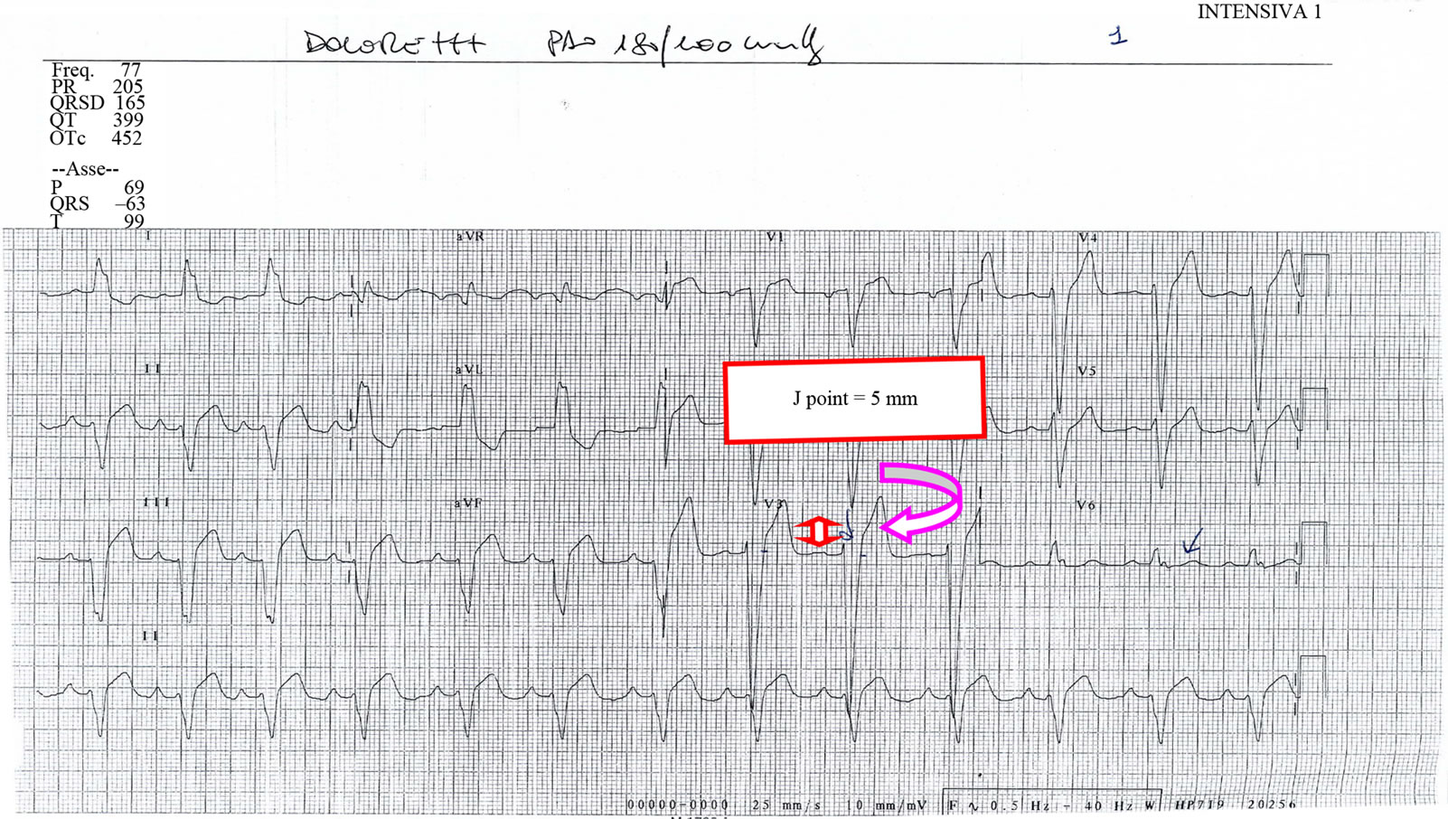 Left bundle branch block and myocardial infarction, a diagnosis not ...