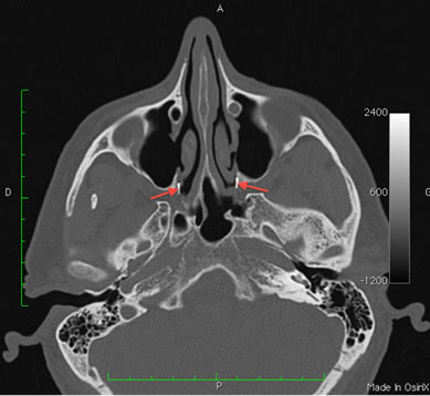 Sphenopalatine Foramen Radiology