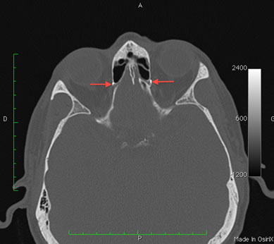 Secondary Signs of Surgical Epistaxis Management