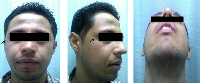 Steimann Pin Repair of Zygomatic Complex Fractures