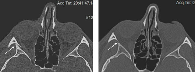 Steimann Pin Repair of Zygomatic Complex Fractures