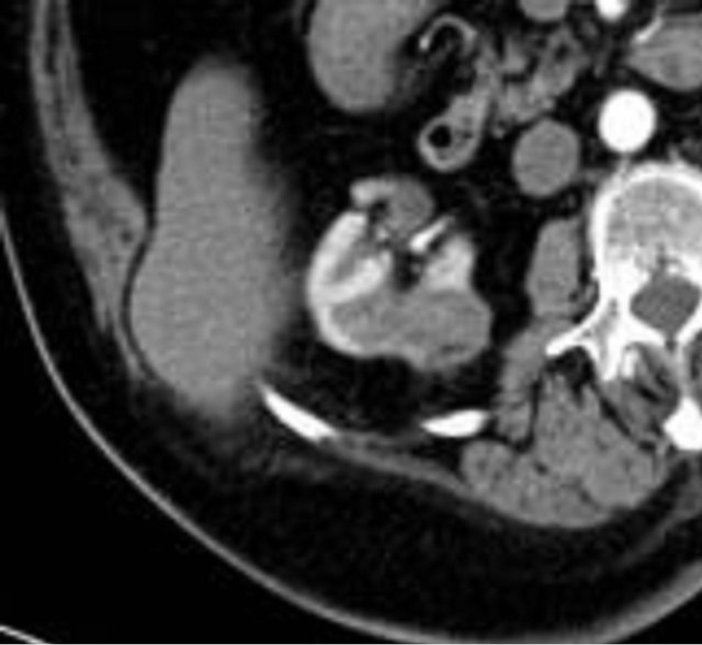 CT Appearance Following Partial Nephrectomy for Renal Cell Carcinoma ...