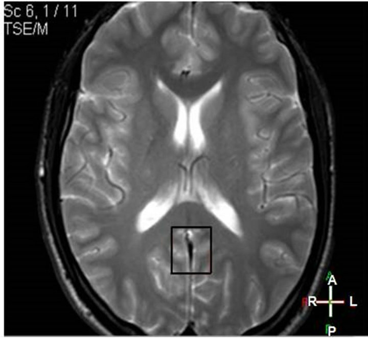 Increased myo-inositol in the posterior cingulate cortex in first ...