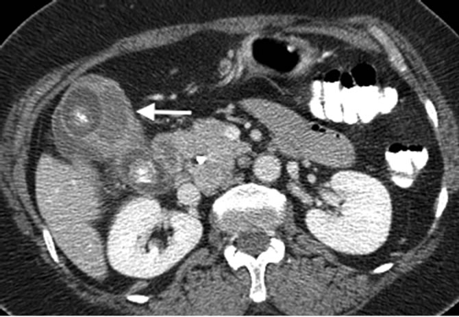Management of Unsuspected Gallbladder Cancer in the Era of Minimally ...