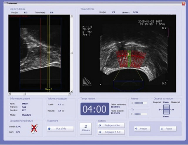 Transrectal High-Intensity Focused Ultrasound for the Treatment of ...