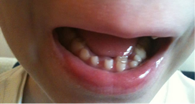 Multiple talon cusps, dens in dente and concrescence in a child with ...