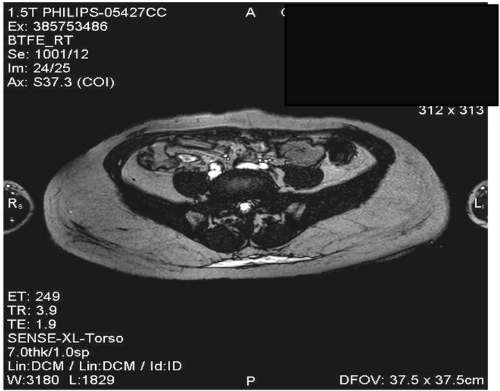 Renal Osteodystrophy in Mullerian, Renal, Cervicothoracic Somite ...