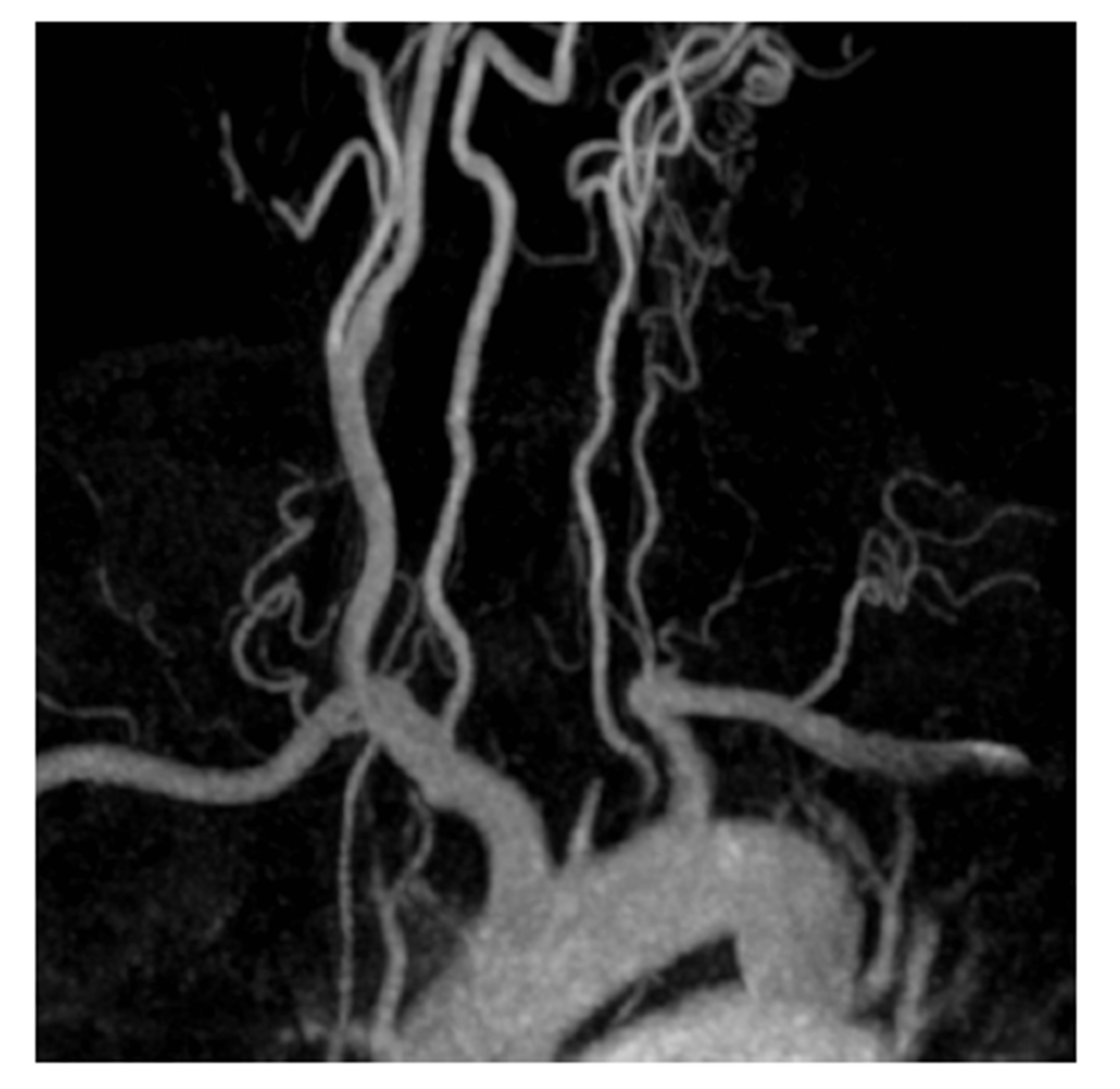 High Resolution MR Angiography of the Posterior Cerebral Circulation ...